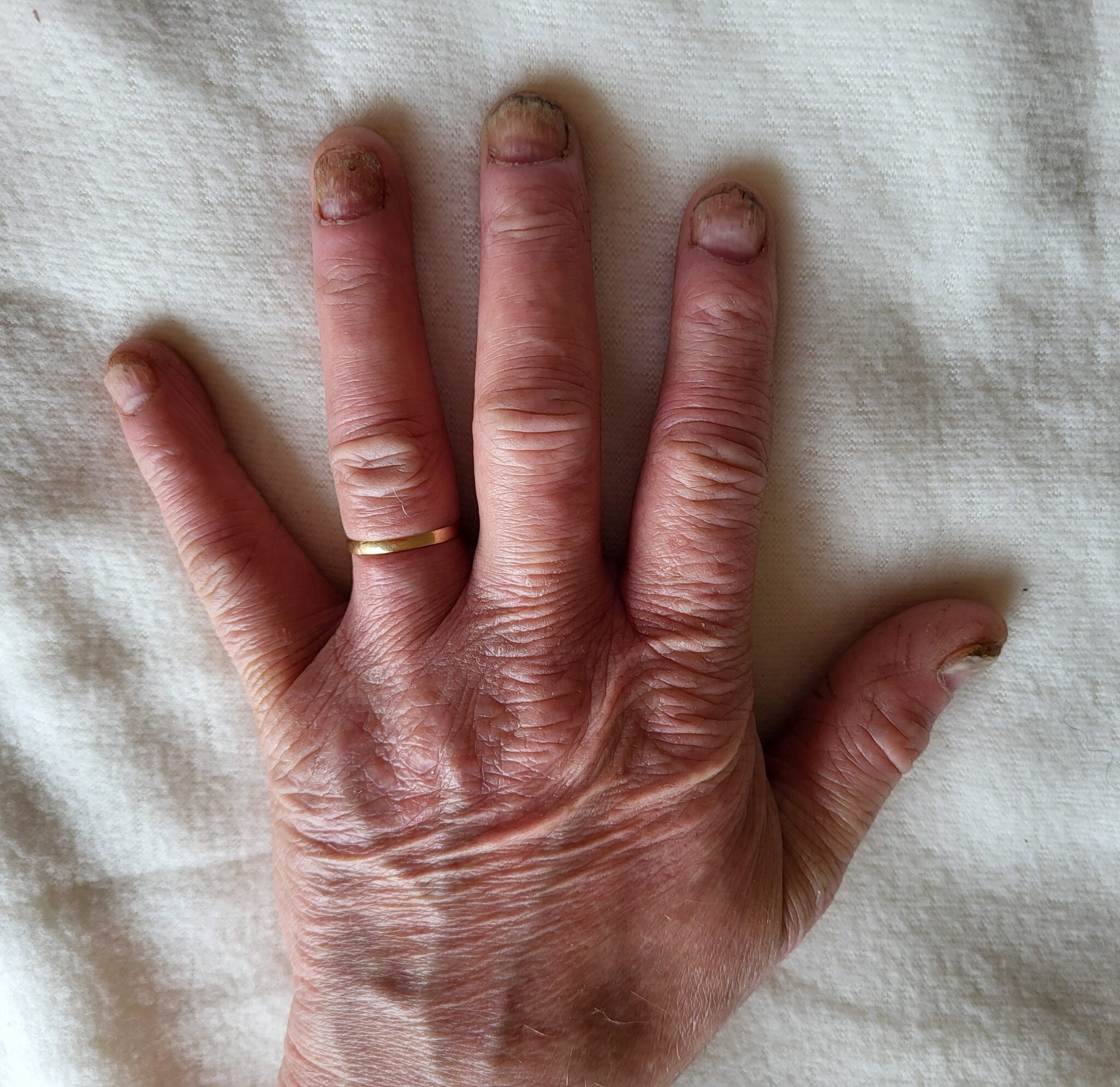 Kynsipsoriasis - Psoriasisliitto