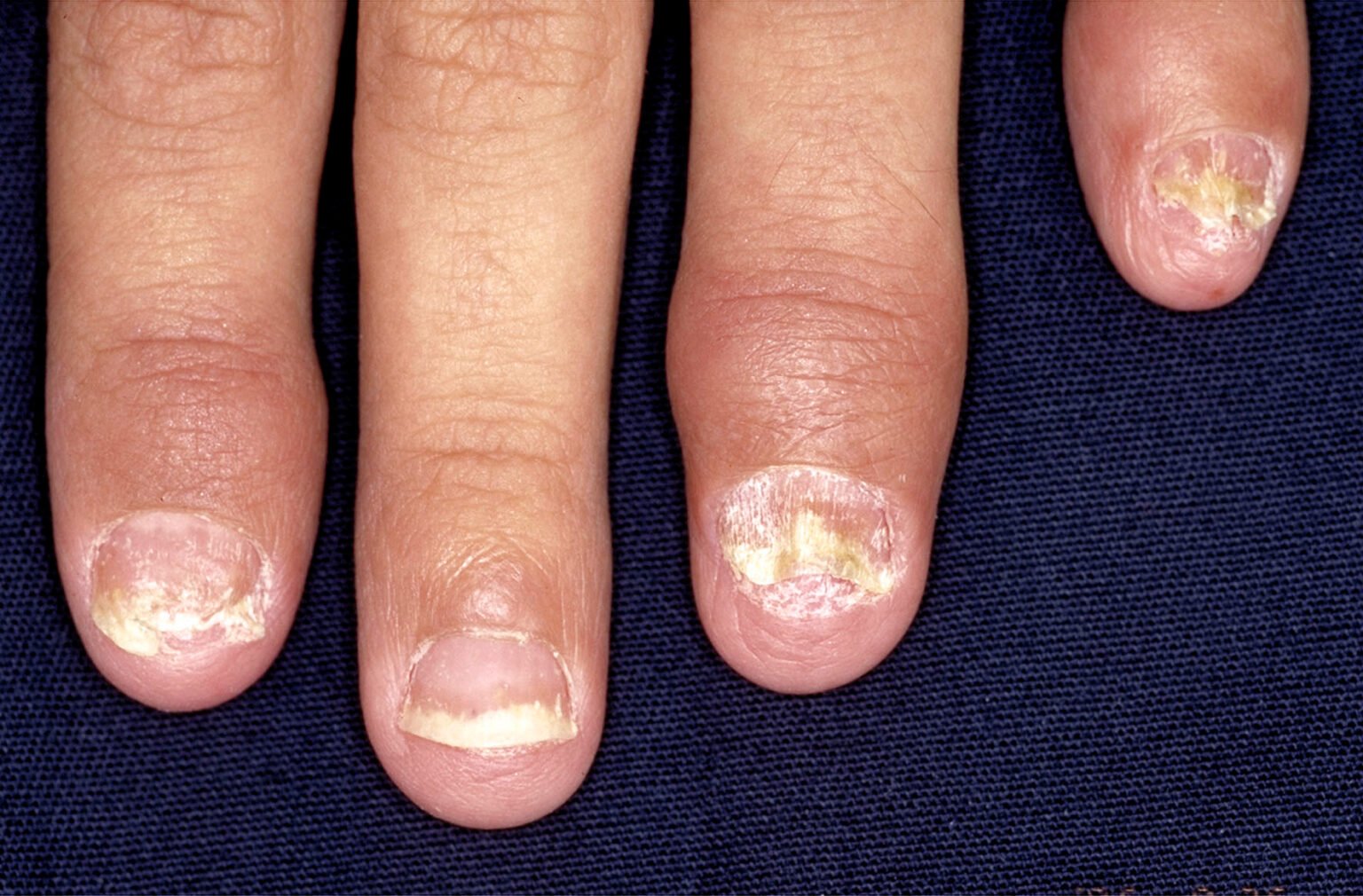 Kynsipsoriasis - Psoriasisliitto