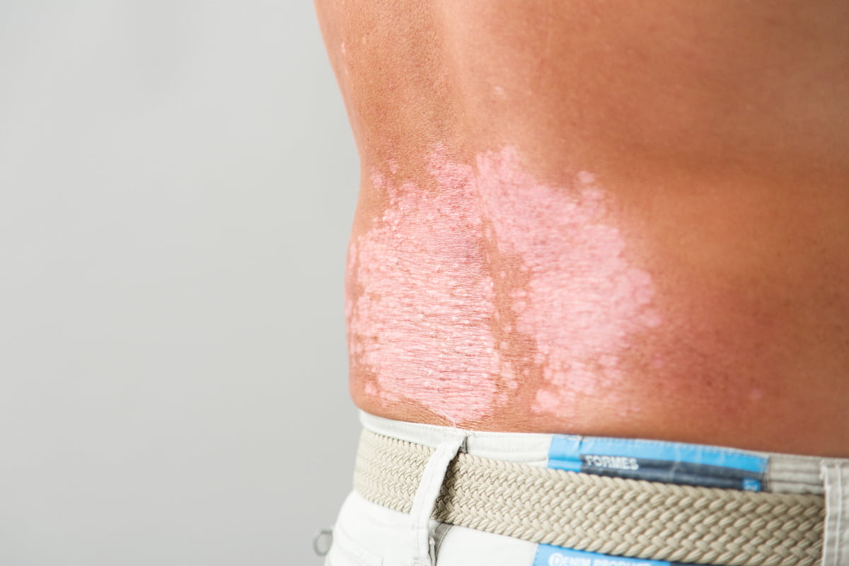 Mikä on psoriasis? - Psoriasisliitto